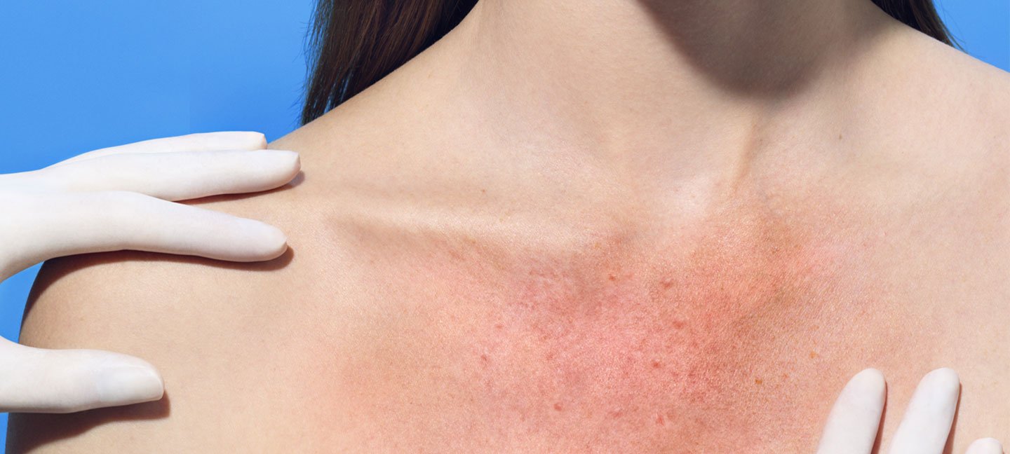 Your Skin Condition Reactive, Allergic Skin : 11 Care And Products By ...