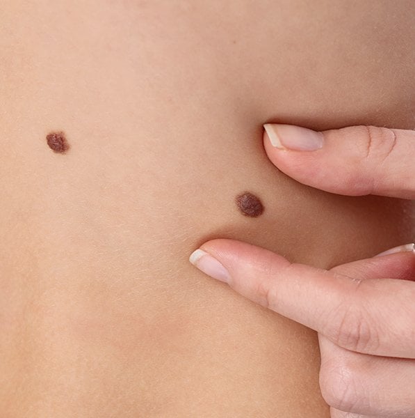 Skin Protection & Advice: Save Your Skin La Roche-Posay