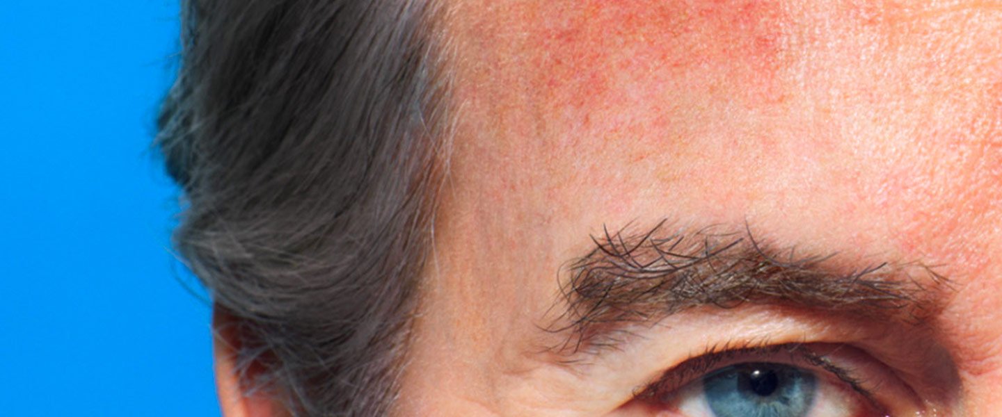 Burnt skin : causes, treatments, products by La Roche-Posay