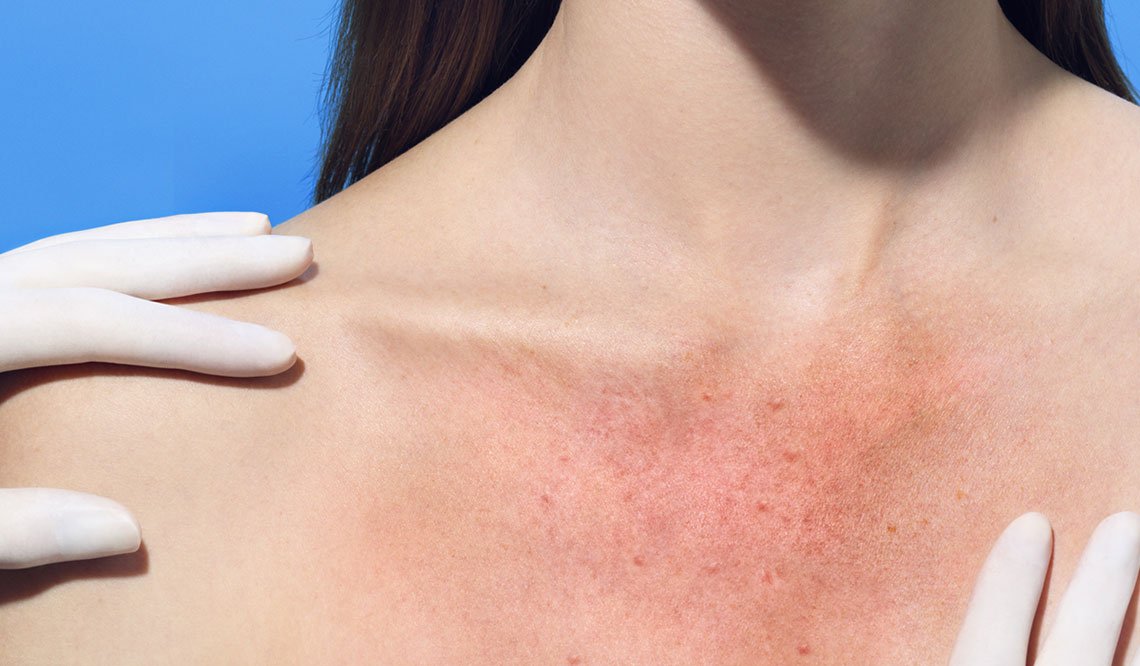 Sun and damaged skin : causes, treatments, products by La Roche-Posay