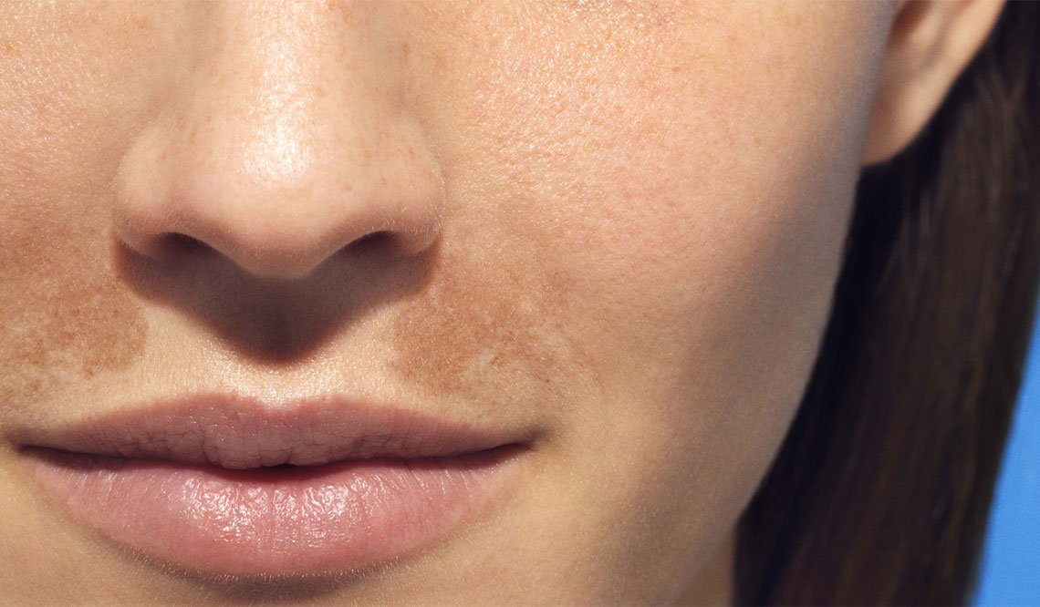 Sun and Pigmentation Pregnancy Melasma : causes, treatments, products ...